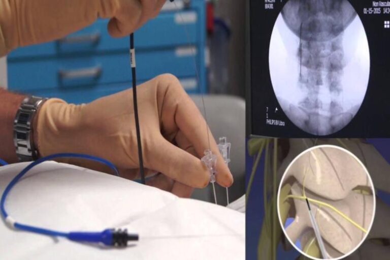 Radiofrequency Ablation Desert Sky Medicine Radiofrequency Ablation Desert Sky Medicine
