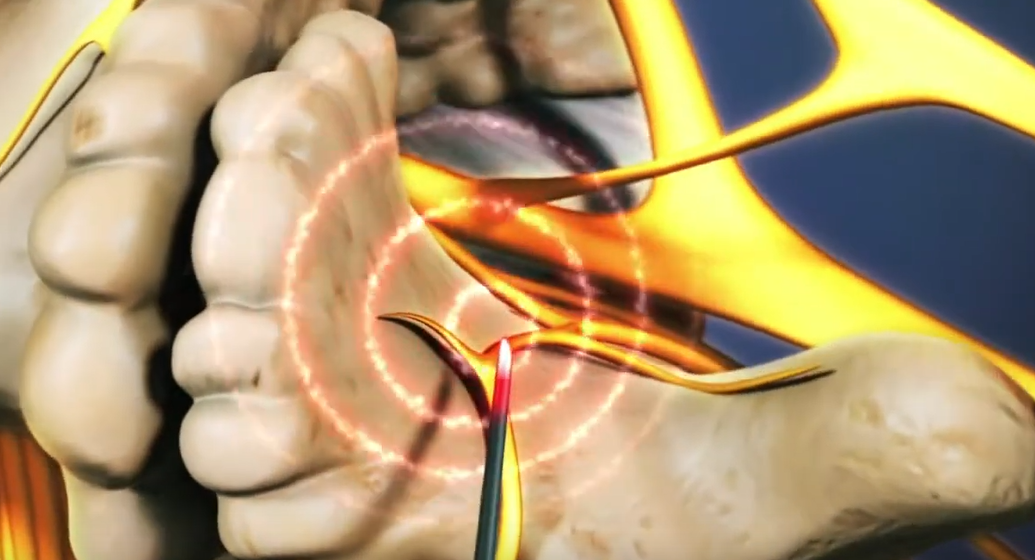 Radiofrequency Ablation (Spinal) - Desert Sky Medicine